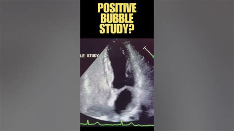 Positive Bubble Study On Echocardiogram — Can You Spot It