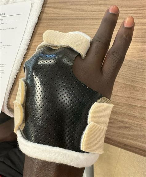 Hand Based Dorsal Blocking Orthosis For Index And Middle Fingers Anna Popova Otr L Cht