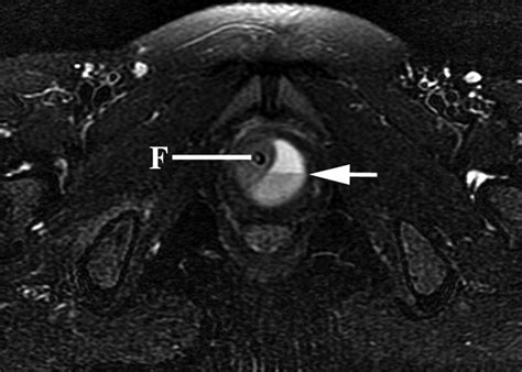 Imaging Of Female Urethral Diverticulum An Update RadioGraphics