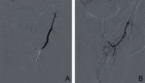 A B Post Embolization Arteriogram Shows A Completely Embolized Left