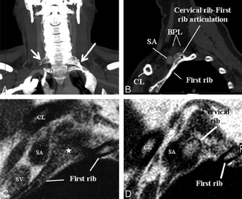 A An Elongated C7 Transverse Process On The Right Small Arrow And