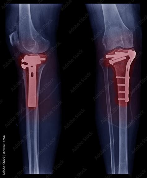 X Ray Image Of Bone Fracture At Tibia And Fibular Right Leg Open