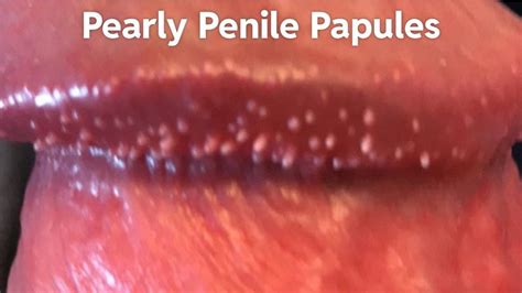 Genital Spots Know The Difference Male Rgenitalhealth