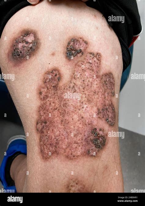 Healing Pyoderma Gangrenosum Lesions On The Leg Of A Patient Who Is