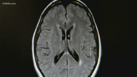What To Look For When It Comes To Declining Cognitive Health