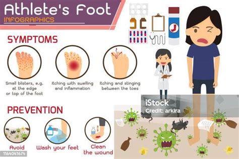 무좀 또는 홍콩 발 질병 인포 그래픽 발에 상처 증상 및 예방 무좀 건강과 의학 만화 벡터 일러스트레이션 건강관리와 의술에 대한