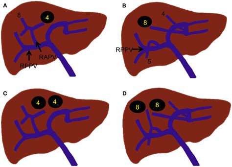 Segmental Or Subsegmental Portal Vein Branches That Cross The Midplane Download Scientific
