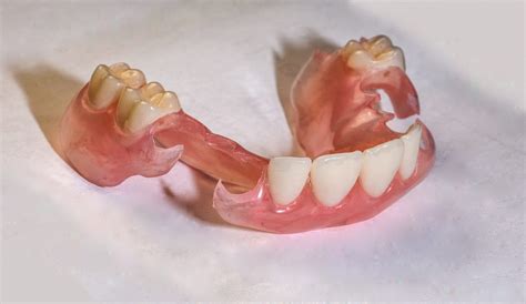 Difference Between Fixed Partial Denture And Removable Partial Denture