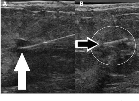 Figure 1 From Reflector Localization Of Breast Lesions And Parameters