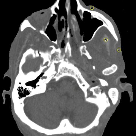 Axial View Of Selection Of Three Circular Regions Of Interest Roi In Download Scientific