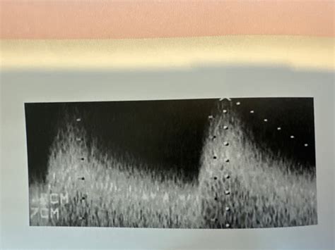 Vascular Avfavg Blood Flow And Characteristics Of Waveforms