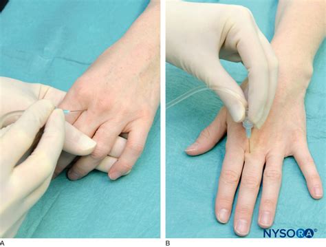 Digital Block Landmarks And Nerve Stimulator Technique Nysora Nysora