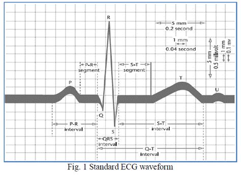 feature vector selection for automatic classification of ecg