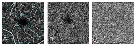 Mm Mm Images Of Macular Perfusion Using Optical Coherence Download Scientific Diagram