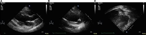 Echocardiographic Images With Poor Endocardial Border Delineation From