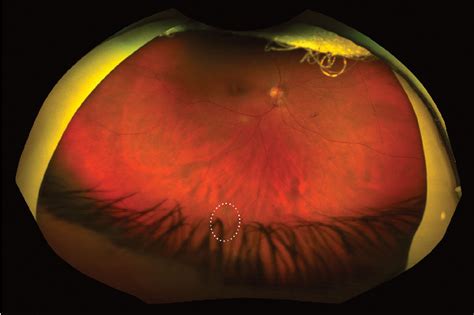 Figure 6 From Deep Learning Based Automated Detection Of Retinal Breaks