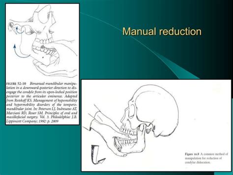 Tmj Dislocation And Its Management Pptx