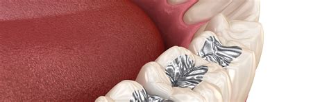 Amalgam Vs Composite Filling In The Gaps Docs Education