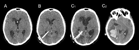 illustrative case vignette of one patient s consecutive ct scans