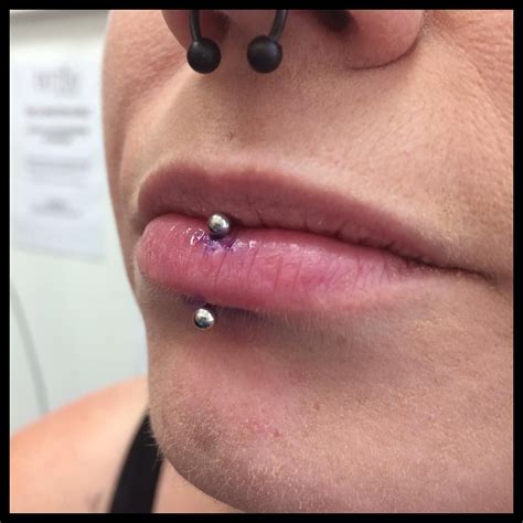 Vertical Labret Piercing Infection