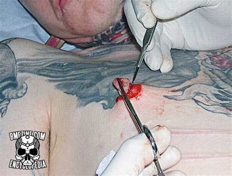File Nipple Removal 2 BME Encyclopedia