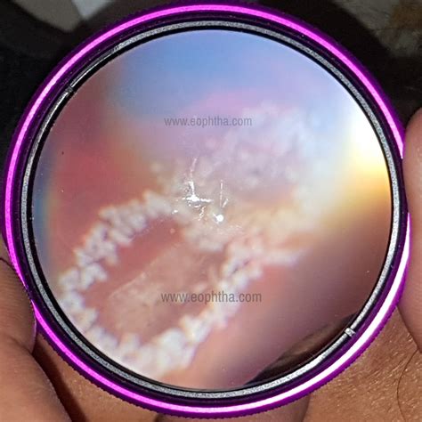 Snail Track Degeneration