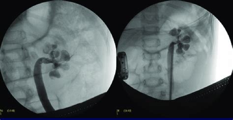 The Retrograde Pyelogram Revealed High Insertion Ureteropelvic