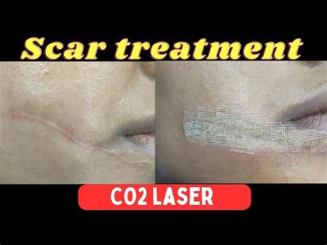 Laser Treatment Of Scar Co2 Laser Treatment For Scar On Face By Dr