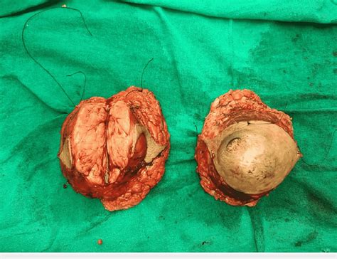 Intraoperative Photograph Of The Excised Bilateral Phyllodes Tumor Download Scientific Diagram