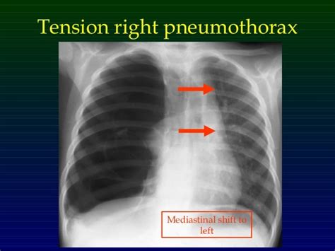 Pneumothorax