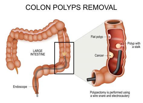 Colonoscopy Clips For Polyps Clip Closure •