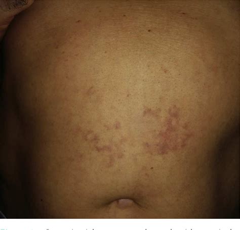 Figure 1 From Skin Rash As The Only Manifestation Of Mild Decompression Sickness Semantic Scholar