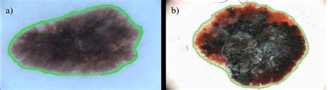 Left Segmentation Of Benign Image Right Segmentation Of Malignant