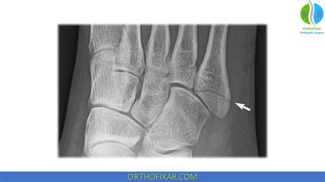 5th Metatarsal Fracture Orthopedic Learning