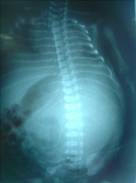 Plain Abdominal X Ray Showing A Large Soft Tissue Mass With Download Scientific Diagram