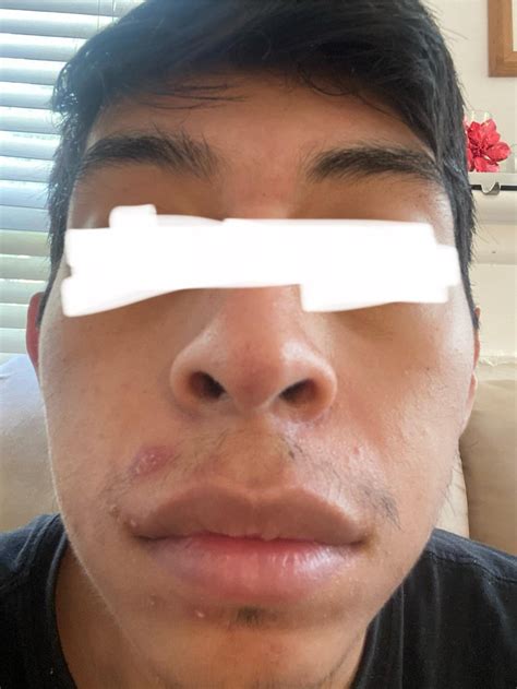 Need Help With My Current Condition Racne