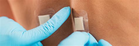 Patch Test For Allergy Why Is It Important Happiest Health