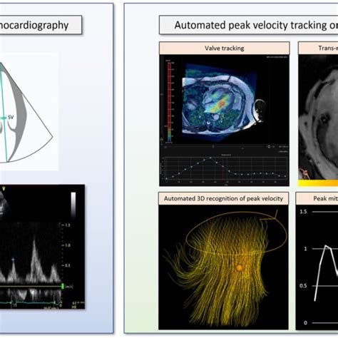 Peak Velocity Measurements With Pulse Wave Transthoracic Download