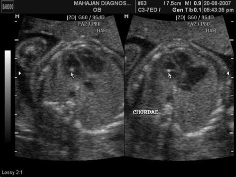 DR ARUN MAHAJAN Echogenic Nodule