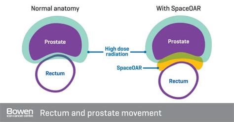 Spaceoar Prostate Hydrogel Spacer — Bowen Icon Cancer Centre