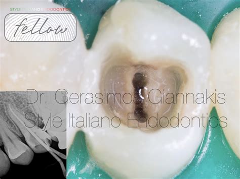 The Restorative Aspect Of Endodontics Part I Pre Endo Build Up Style Italiano Endodontics