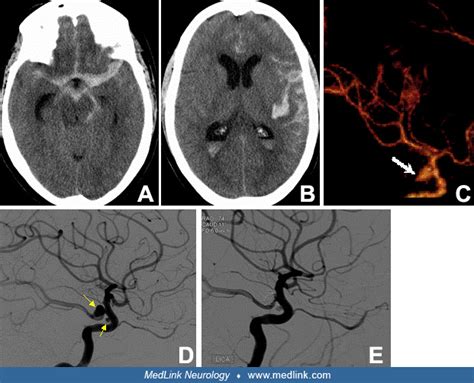 Subarachnoid Hemorrhage