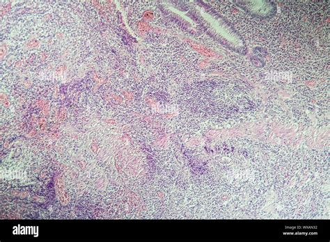 Crohns Disease Intestinal Inflammation Under The Microscope 100x Stock