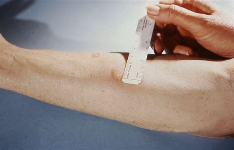 Tb Skin Test Burnaby 1 Step And 2 Step Tst For Work School