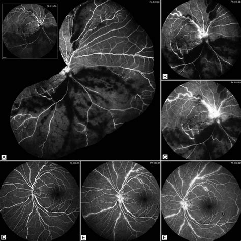 Paracentral Acute Middle Maculopathy With Occlusive Retinal Vasculitis