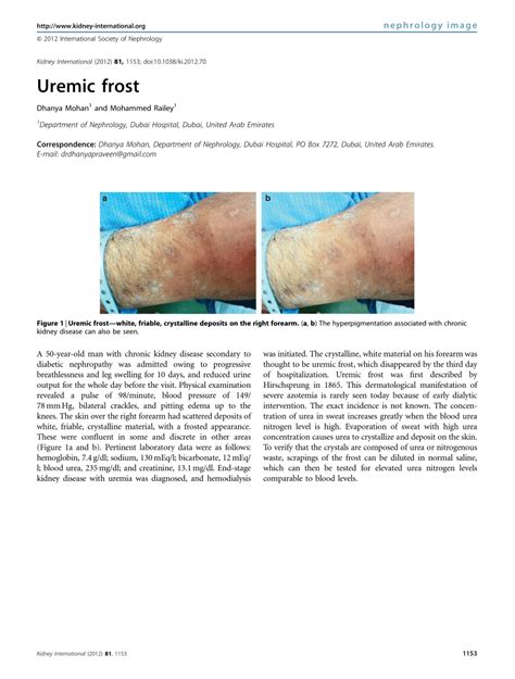 Pdf Uremic Frost