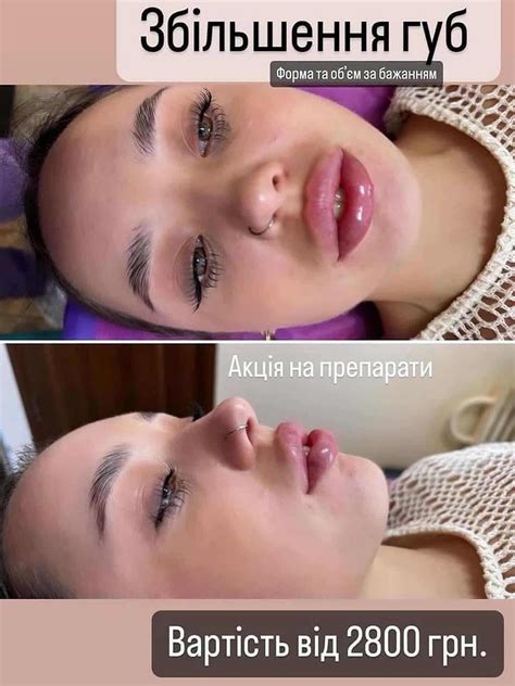 Ищу модель Днепр 🇺🇦 Шукаю модель Дніпро АКЦІЯ на контурну пластику 🔥🔥🔥 📌губки Вартість 2800