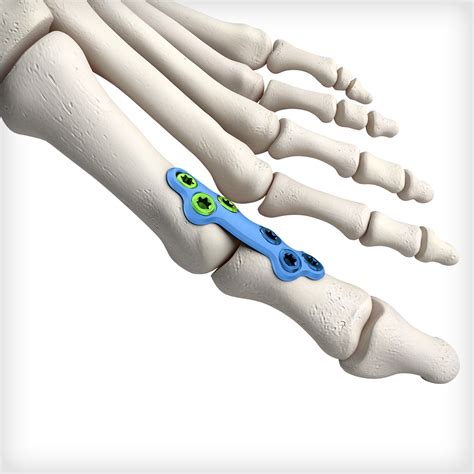 Hallux Rigidus Stiff Big Toe Symptoms Causes And Treatment Pure