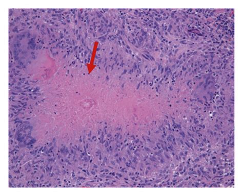 Left Inguinal Lymph Node Biopsy With Necrotizing Granuloma Download Scientific Diagram