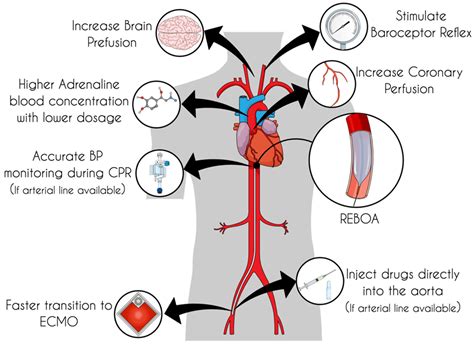 Resuscitative Endovascular Balloon Occlusion Of The Aorta Reboa In
